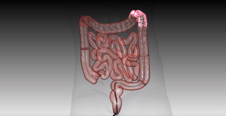 Colonoscopy Endoscope 3D Medical Animation - Medical 3D Scientific ...